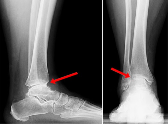 Learn about Total Ankle Replacement,Total Ankle Surgery | total ankle ...