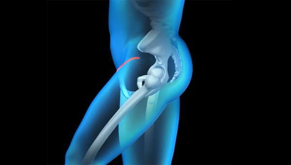 Bikini MIS Hip Replacement: Benefits, Procedure & Expert Care